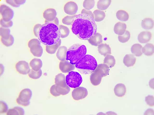 Small Lymphocytic Lymphoma (SLL): Stats, Causes and Diagnosis | PayItLess